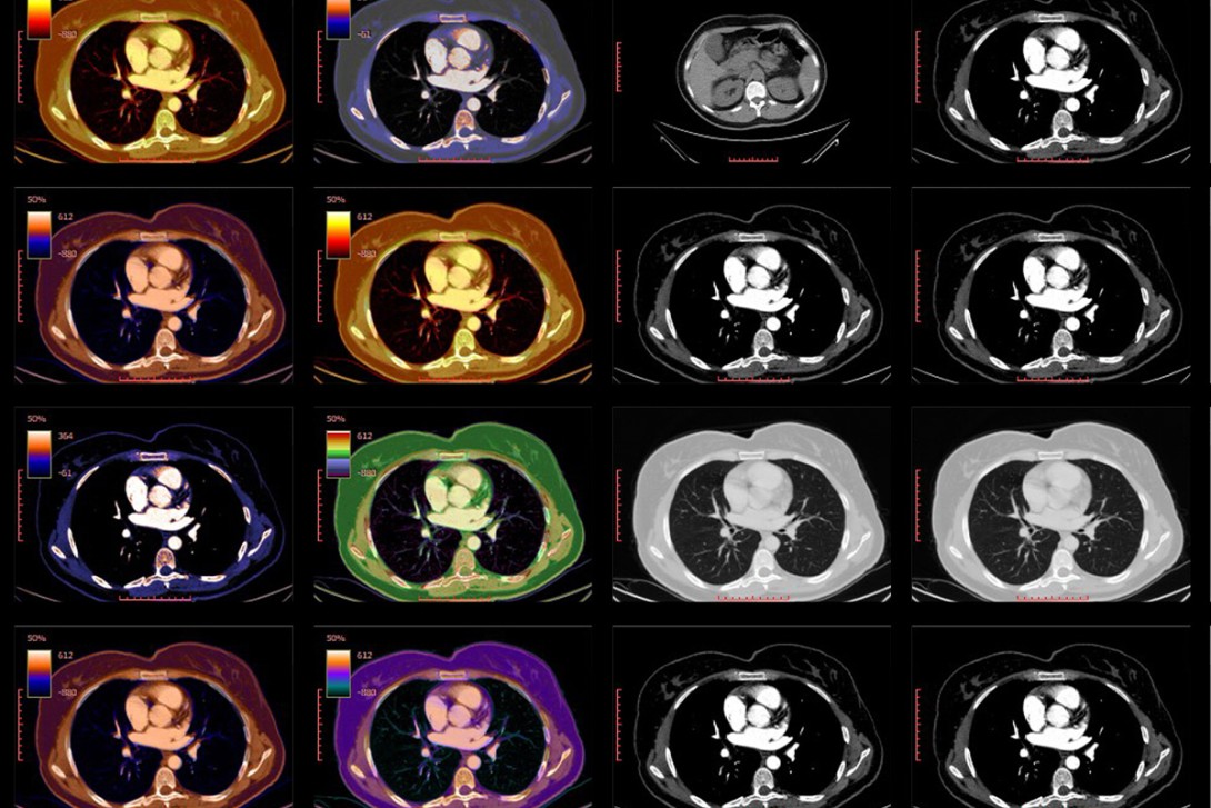 Interstitial lung abnormality discovery: a path to early intervention ...